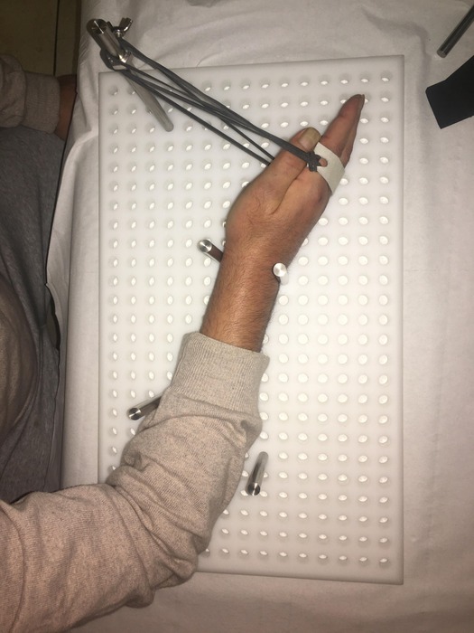 Traumatologie: fracture radiale distale avec broche :: Cabinet-de ...